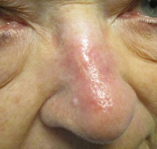 MOHS Surgery Photos | Before & After | ADC Derm