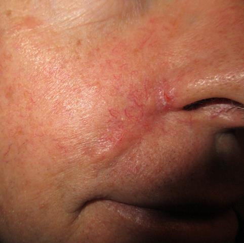 MOHS Surgery Photos | Before & After | ADC Derm