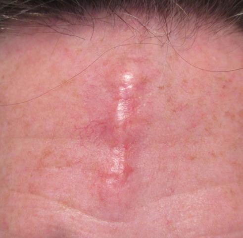 MOHS Surgery Photos | Before & After | ADC Derm