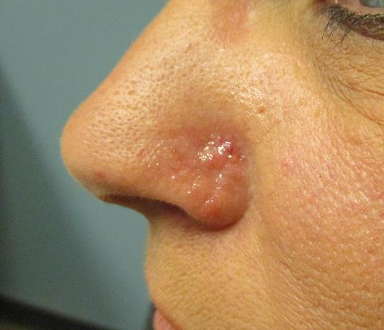 Mohs Surgery Photos Before And After Adc Derm