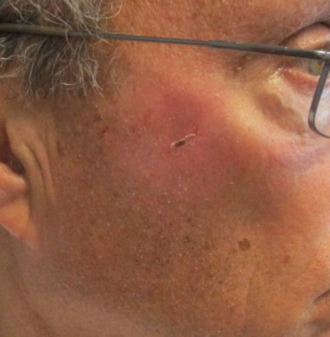 MOHS Surgery Photos | Before & After | ADC Derm