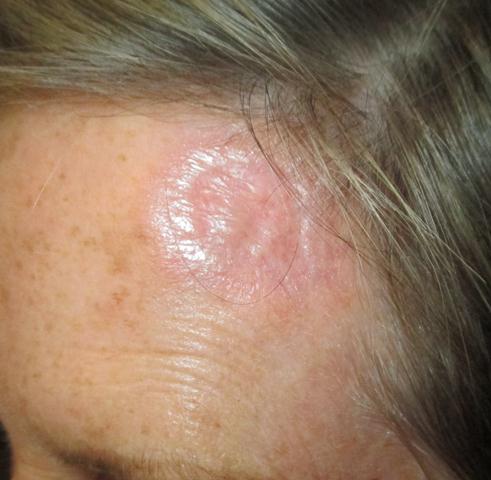 MOHS Surgery Photos | Before & After | ADC Derm