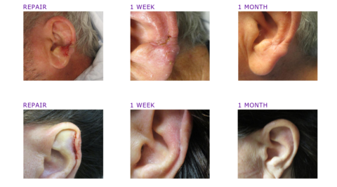 MOHS Surgery Photos | Before & After | ADC Derm
