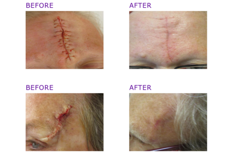 MOHS Skin Cancer Surgery | Before & After Surgery Photos