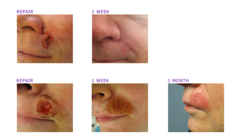 MOHS Surgery Photos | Before & After | ADC Derm