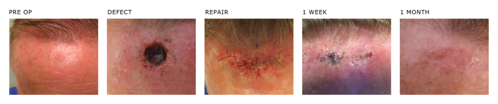 MOHS Surgery Photos | Before & After | ADC Derm